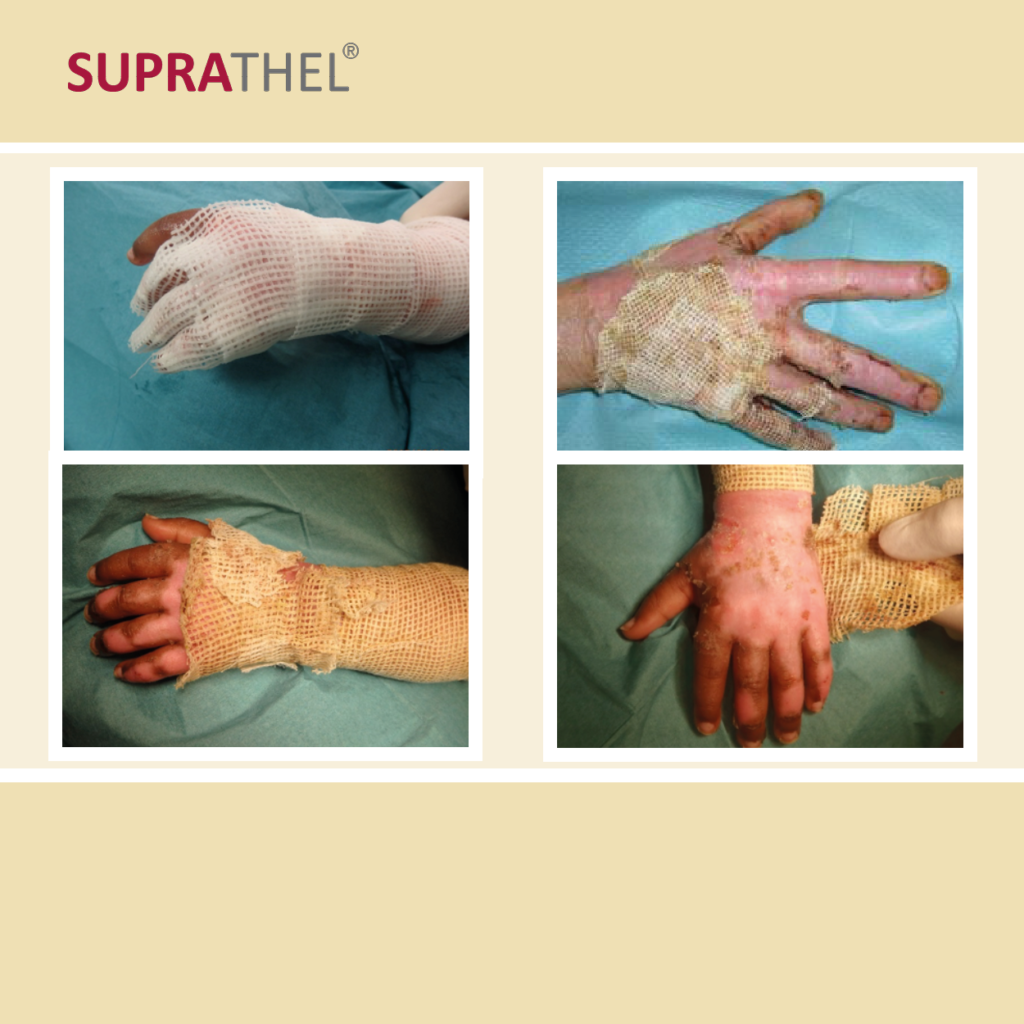 Plataforma de Formación en ventas de SUPRATHEL® – Polymedics