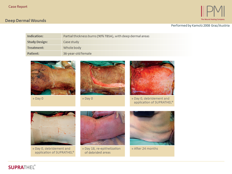 2. Medical Compendium – Deep Dermal Burns overview – Polymedics